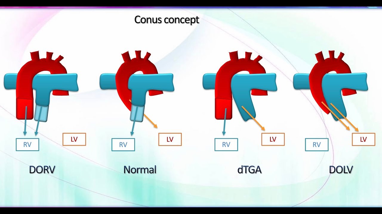 Unlocking Insights: Mastering Fetal Echo in Conotruncal Anomalies ...